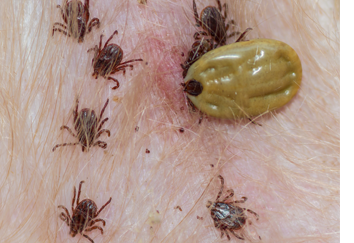 Tick Pest Control Montgomery County - PA Tick Control - Patriot Pest ...